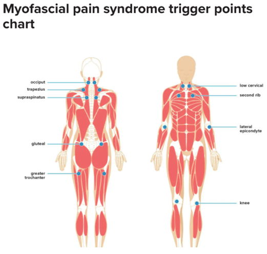 Myofacial Pain Syndrome Treatments, Symptoms & Causes | Headache TMJ
